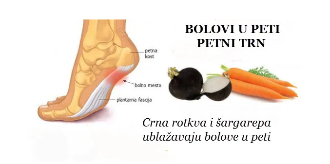 Muči vas petni trn, ovo je najbrži način da se oslobodite bolova! Sve što Vam je potrebno već imate!